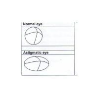 Astigmatism | Vision Infinity Optometrist