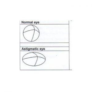 Astigmatism | Vision Infinity Optometrist