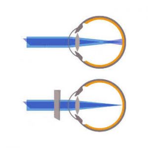 Astigmatism | Vision Infinity Optometrist