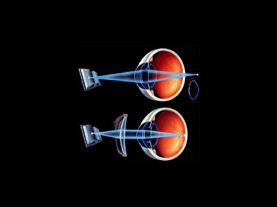 Presbyopia | Vision Infinity Optometrist