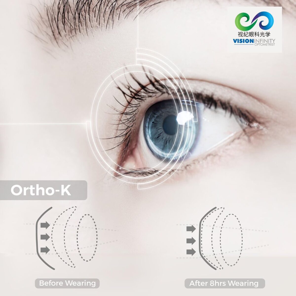 What is Orthokeratology (Ortho-K)? | Vision Infinity Optometrist